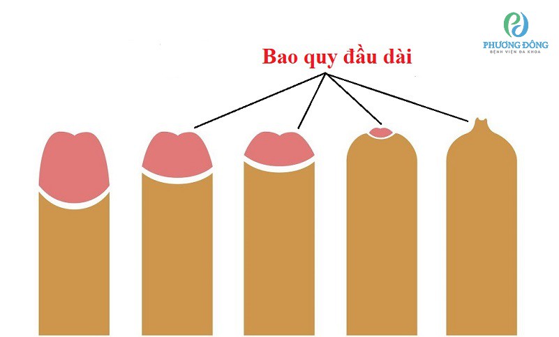Bao Quy đầu Dài Cách Nhận Biết Nguyên Nhân Và Cách điều Trị Phù Hợp