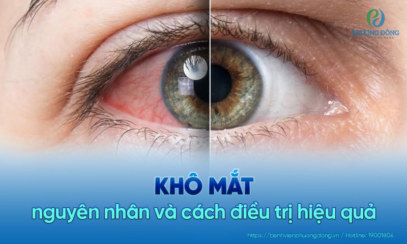 Khô mắt: Tìm hiểu nguyên nhân và cách điều trị áp dụng hiện nay