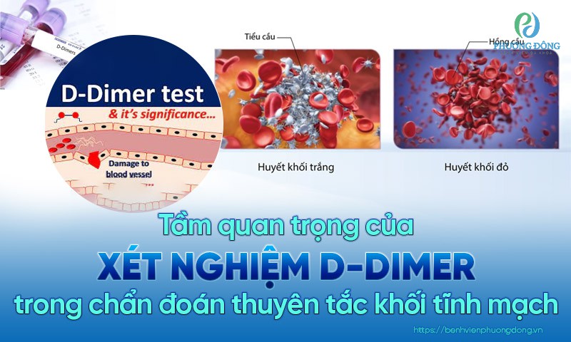 Tìm hiểu về phương pháp xét nghiệm D-dimer phổ biến