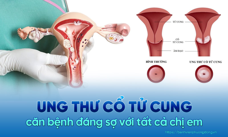 Xét nghiệm ung thư cổ tử cung để có biện pháp điều trị kịp thời