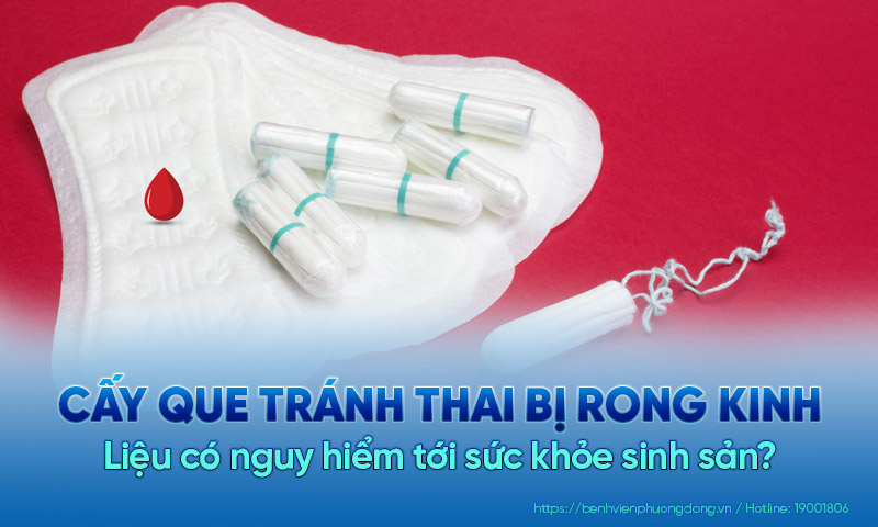 Nguyên nhân và cách điều trị bị rong kinh khi cấy que tránh thai hiệu quả