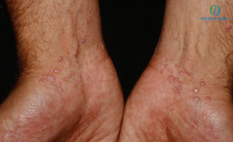 Lichen phẳng là gì? Nguyên nhân, triệu chứng và cách điều trị