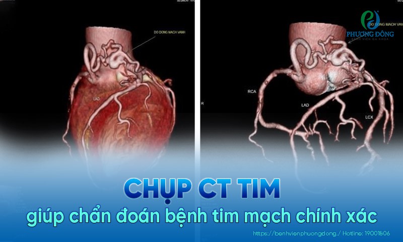 Chụp CT tim: Mục đích, đối tượng và quy trình chụp cắt lớp tim mạch