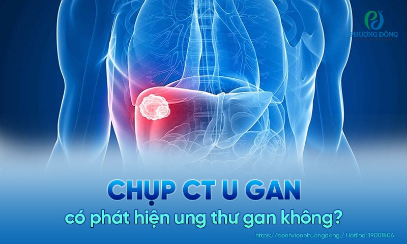 Chụp CT u gan để làm gì? Có phát hiện ung thư gan không?