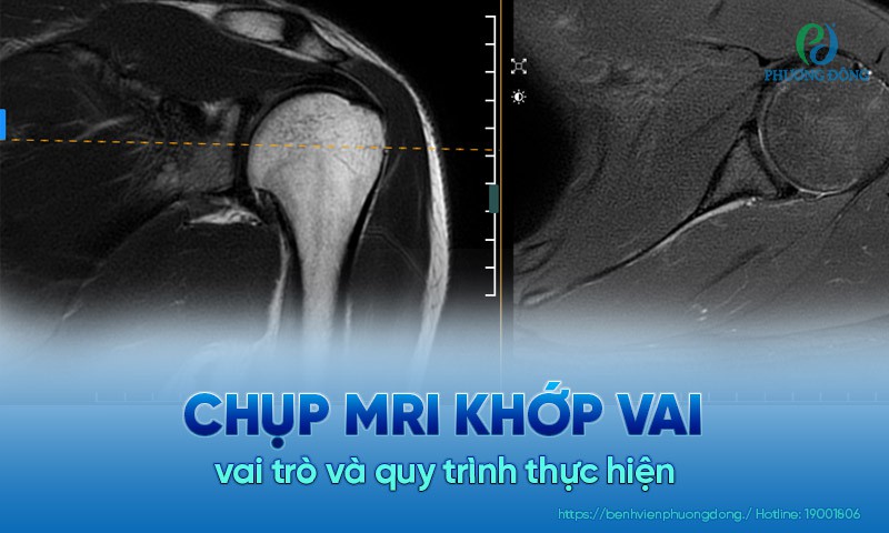 Chụp MRI khớp vai là gì? Ai không nên chụp cộng hưởng từ khớp vai?