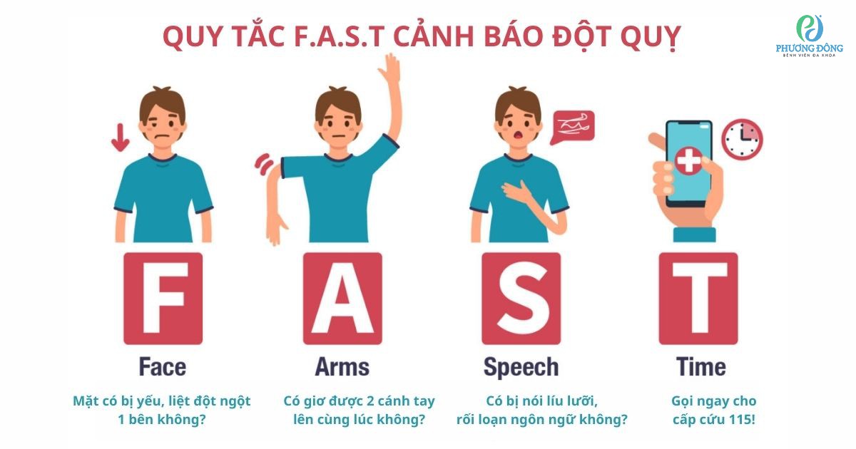 FAST đột quỵ: Dấu hiệu nhận biết nhanh cơn đột quỵ